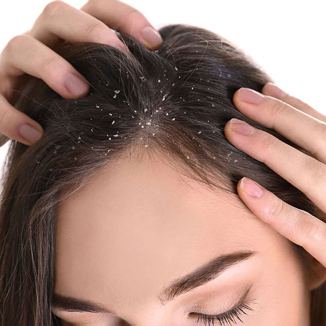 Best Dandruff & Greasy Scalp Treatment – Hair Affairs by MS